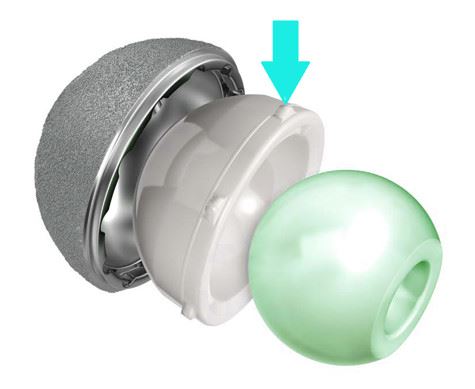 DePuy ALTRx Hip Replacement | Cleveland Injury Firm